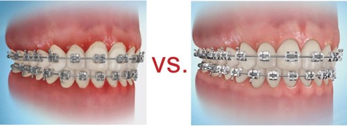 Caring for Braces - i-Orthodontics - San Deigo CA